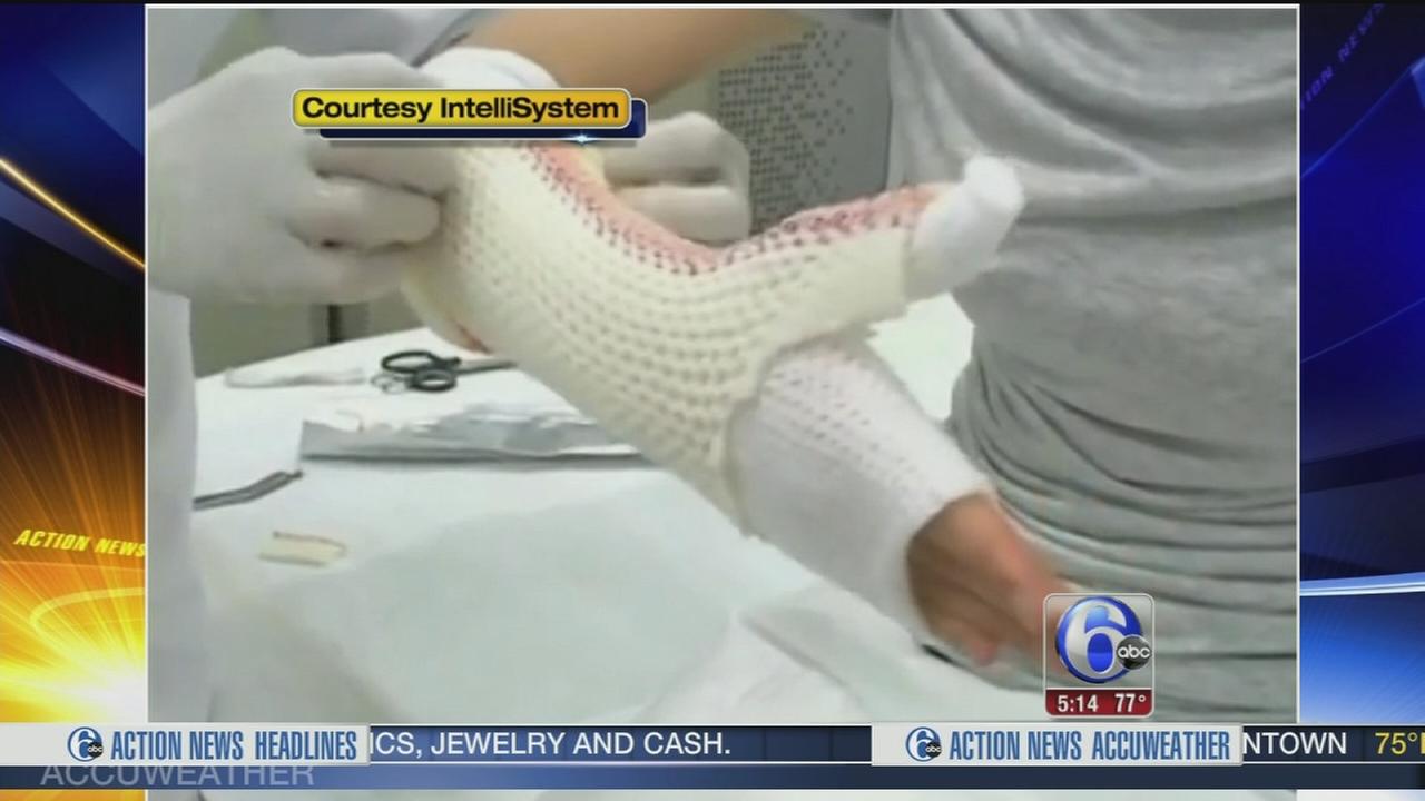 Lighter, more breathable, water-friendly cast for some broken bones ...